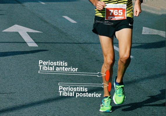 Periostitis tibial: causas, tratamiento y ejercicios para aliviar el dolor